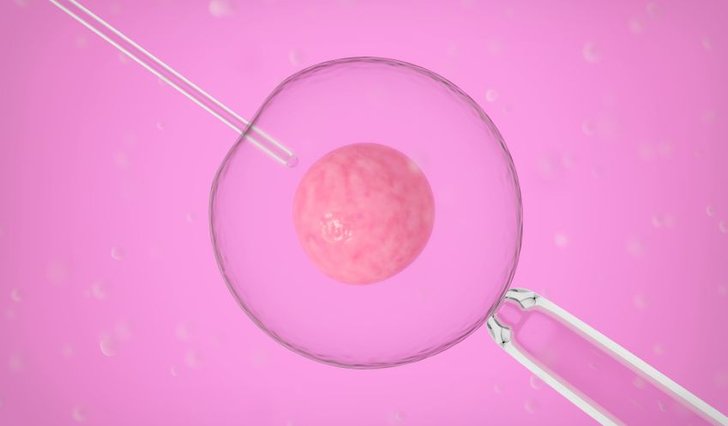 Intrauterine Insemination - IUI Procedure