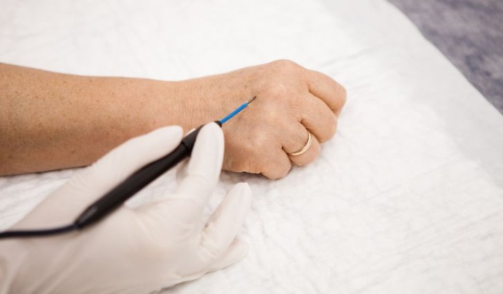 Wart Removal: Electrodesiccation