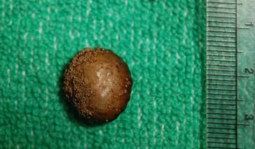 Bladder Stones Treatments