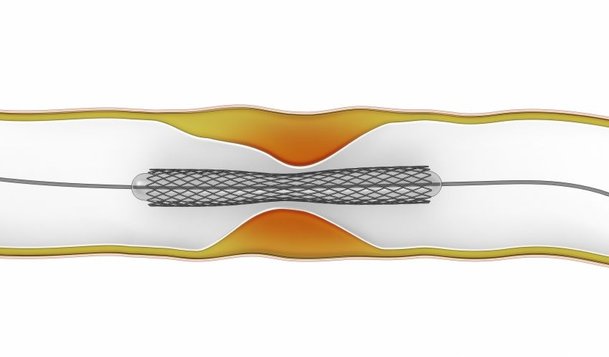 Vascular Stenting and Stent Placement Surgery Info
